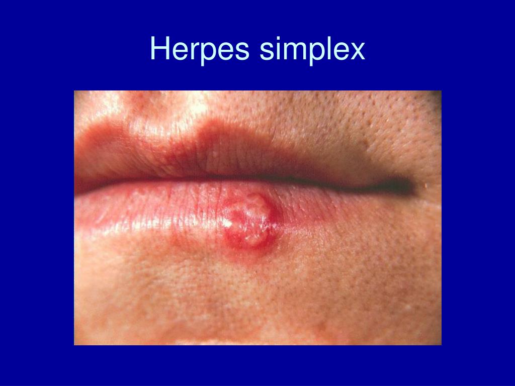 PPT - Clinical Aspects of HIV Disease PowerPoint Presentation, free ...