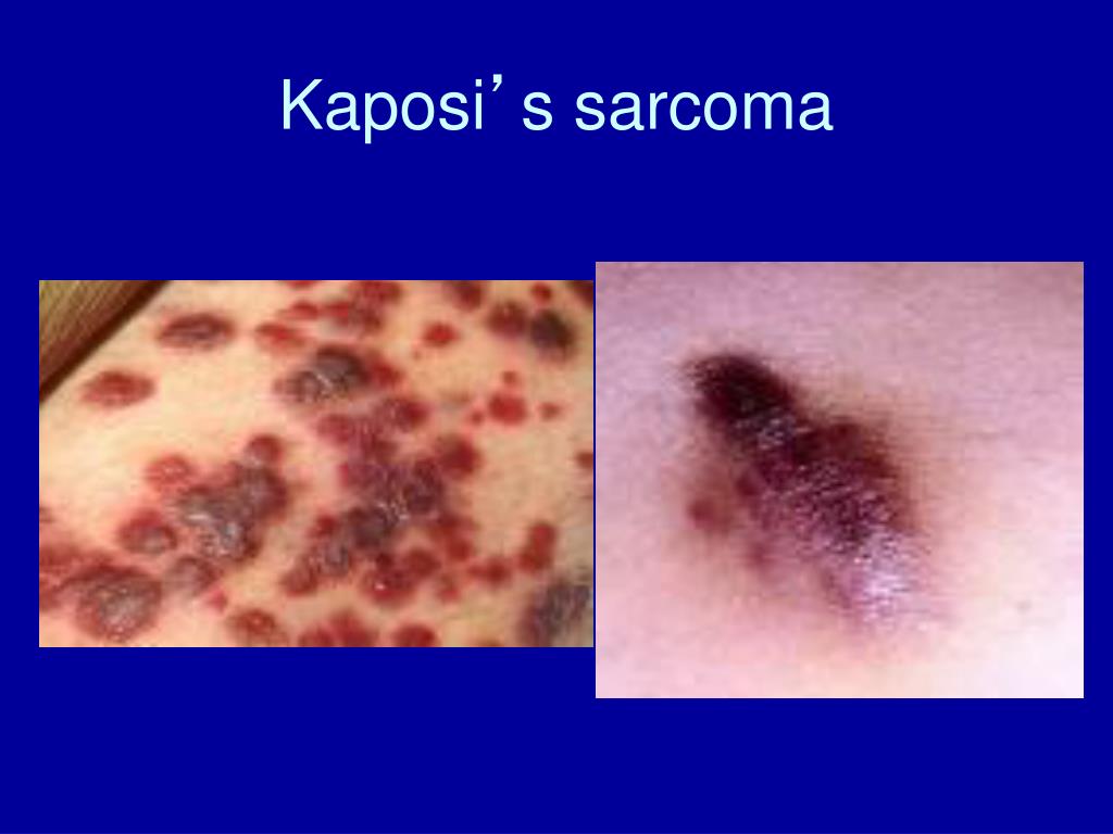 PPT - Clinical Aspects of HIV Disease PowerPoint Presentation, free ...