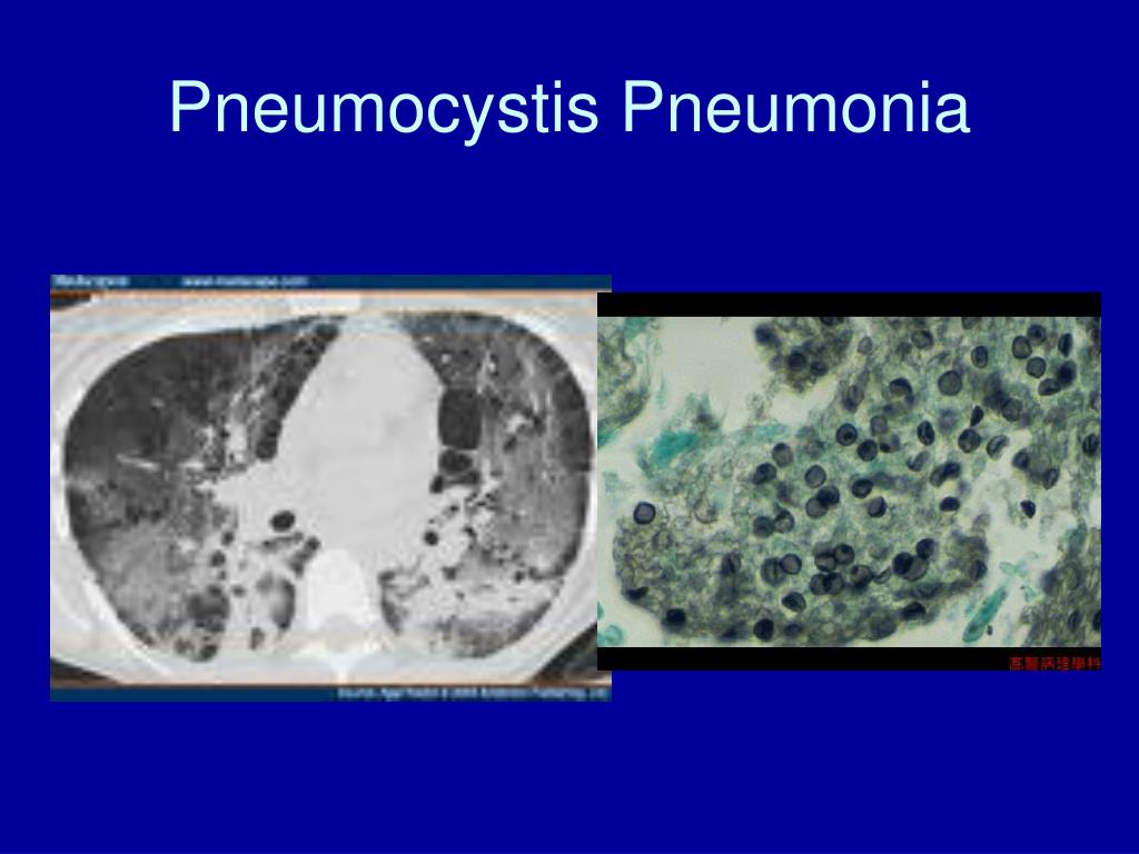 PPT - Clinical Aspects of HIV Disease PowerPoint Presentation, free ...