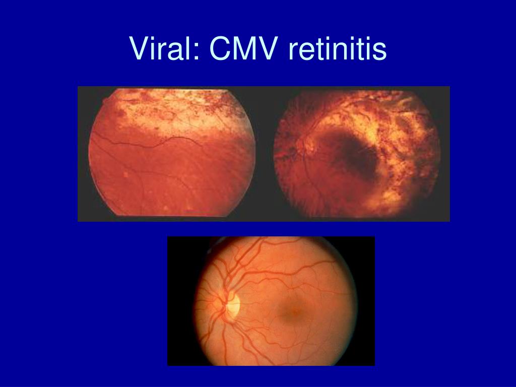 PPT - Clinical Aspects of HIV Disease PowerPoint Presentation, free ...