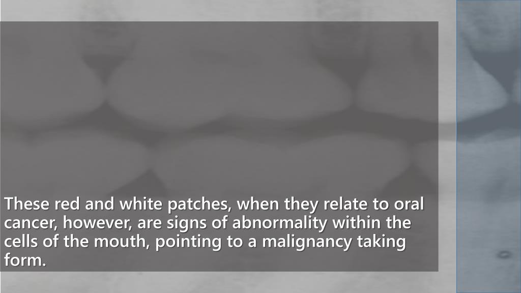 PPT - What are the Signs and Symptoms of Oral Cancer? PowerPoint ...
