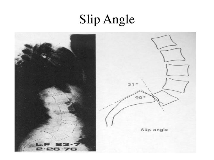PPT - Spondylolysis and Spondylolisthesis PowerPoint Presentation - ID ...