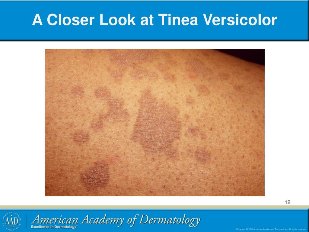PPT - Adult Cutaneous Fungal Infections 2: Yeasts PowerPoint ...