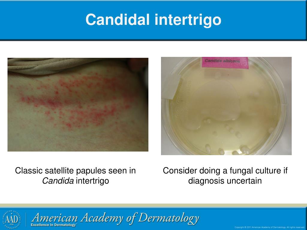 PPT - Adult Cutaneous Fungal Infections 2: Yeasts PowerPoint ...