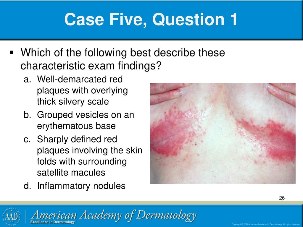 PPT - Adult Cutaneous Fungal Infections 2: Yeasts PowerPoint ...
