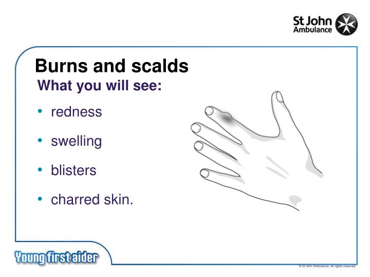 PPT - Burns and scalds PowerPoint Presentation - ID:2736360