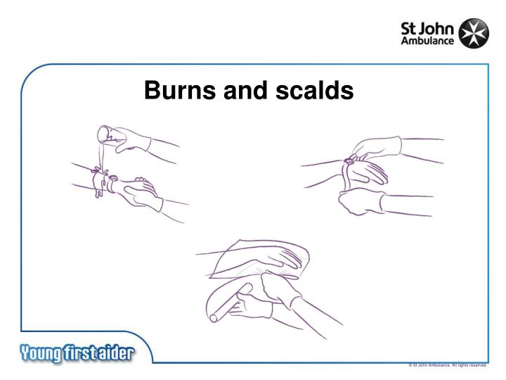 PPT - Burns and scalds PowerPoint Presentation - ID:2736360