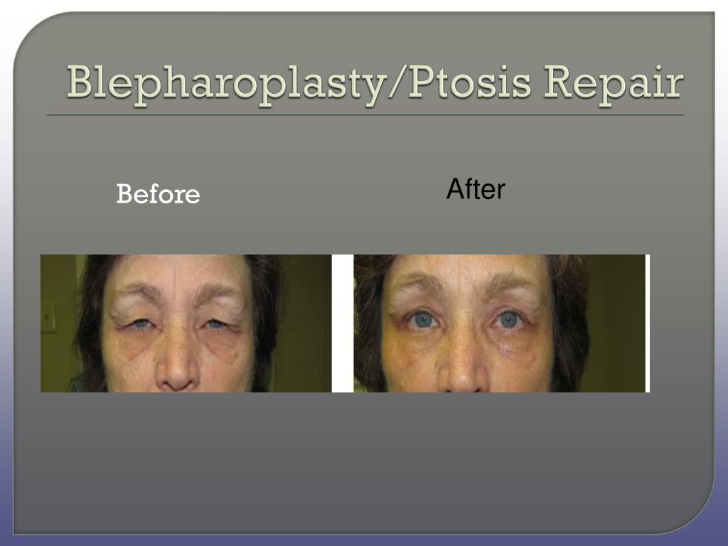 PPT - Eyelid, Tear Duct, and Orbital Surgery PowerPoint Presentation ...
