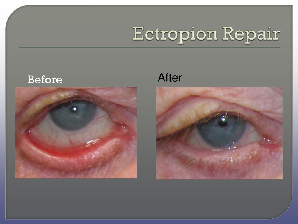 PPT - Eyelid, Tear Duct, and Orbital Surgery PowerPoint Presentation ...