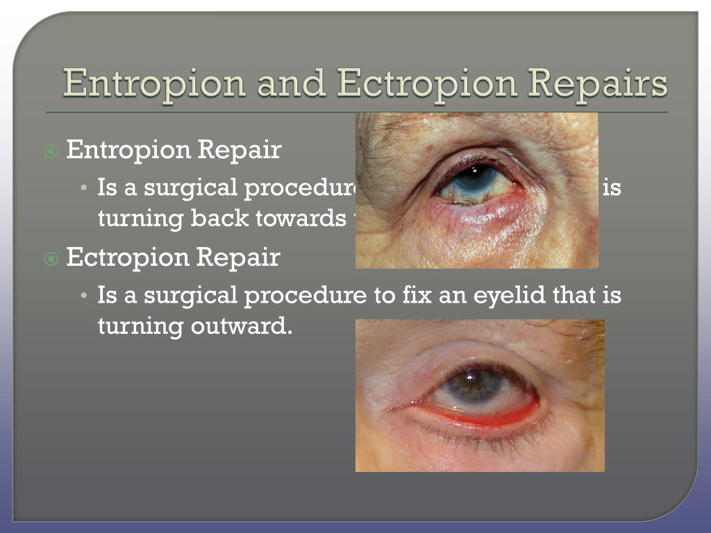 PPT - Eyelid, Tear Duct, and Orbital Surgery PowerPoint Presentation ...