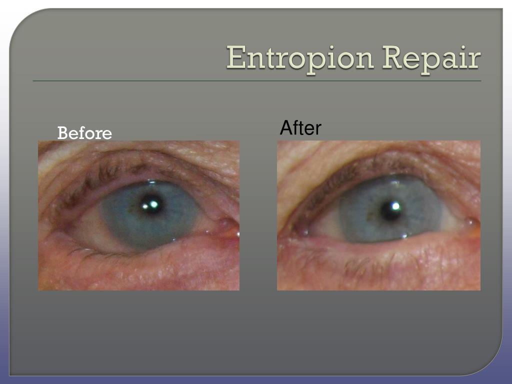 PPT - Eyelid, Tear Duct, and Orbital Surgery PowerPoint Presentation ...