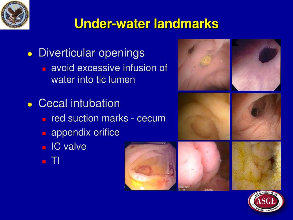 PPT - Water-aided Colonoscopy: water immersion & water exchange ...