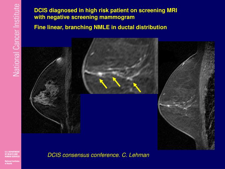 PPT - Ductal Carcinoma In Situ (DCIS) PowerPoint Presentation - ID:2746157