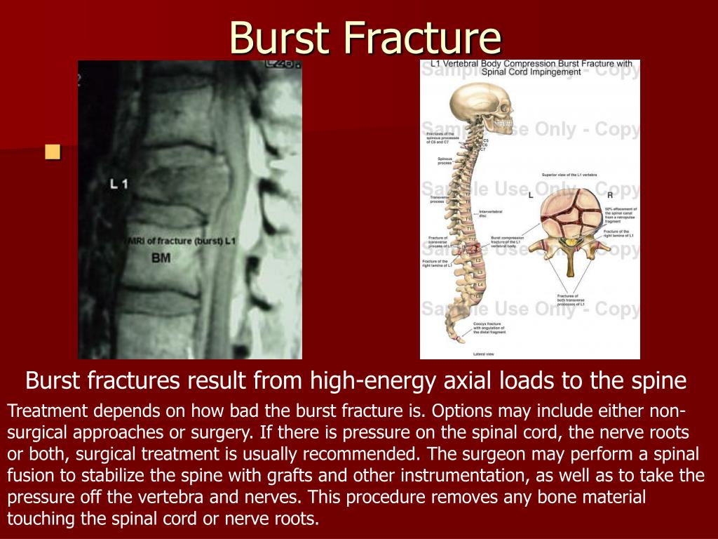 PPT - Follow up CT scan on 20 year old male with back pain PowerPoint ...