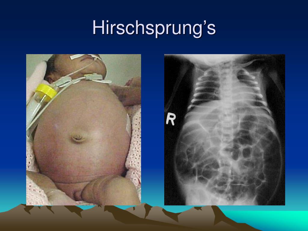 PPT - Bowel Obstruction: Infants and Children PowerPoint Presentation ...