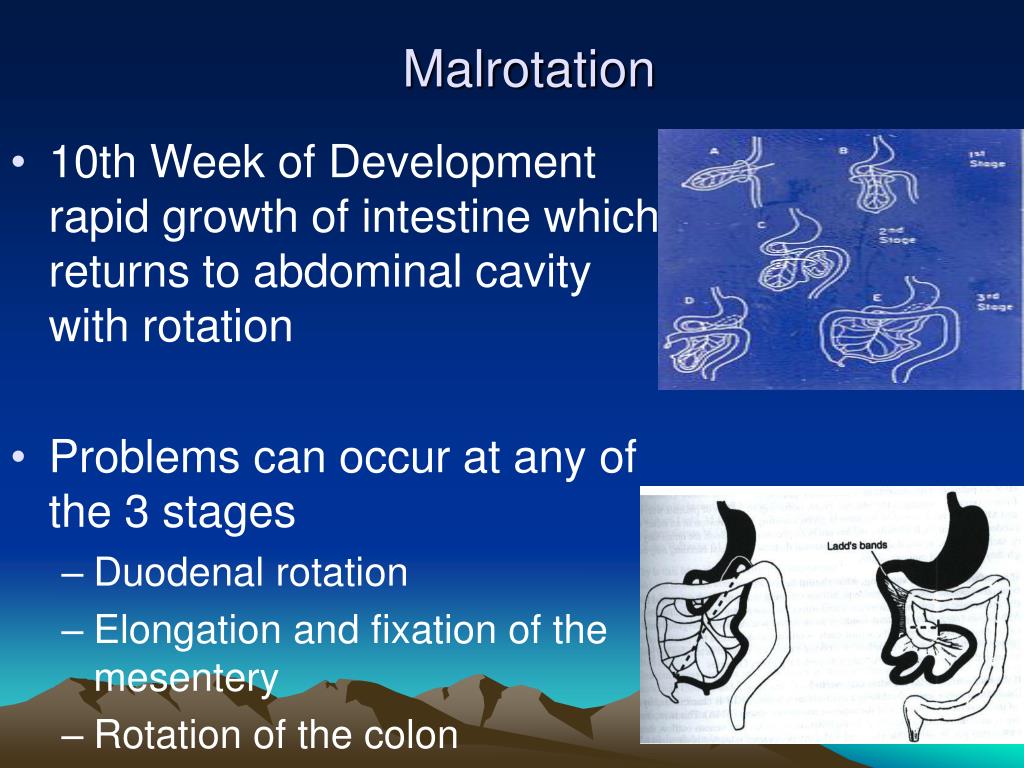 PPT - Bowel Obstruction: Infants and Children PowerPoint Presentation ...