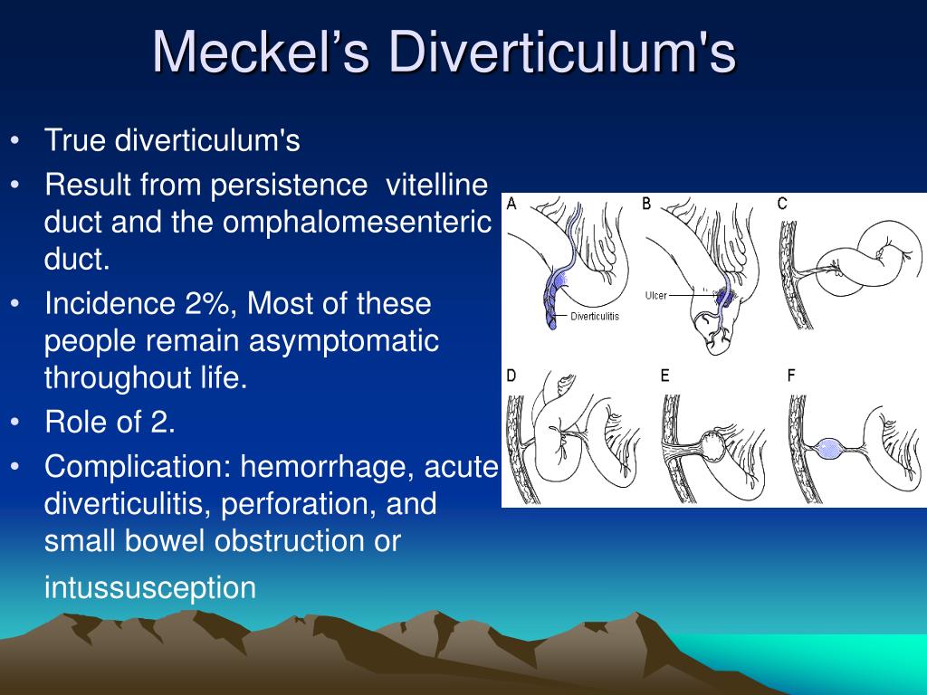 PPT - Bowel Obstruction: Infants and Children PowerPoint Presentation ...