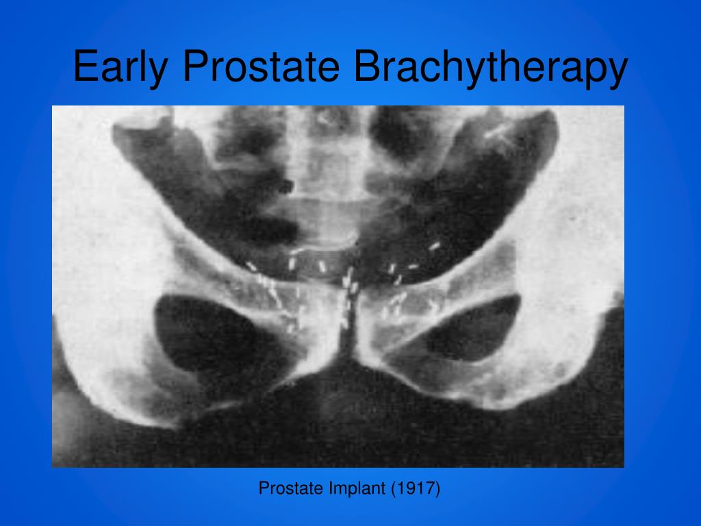 PPT - Radiation Therapy in Prostate Cancer Current Status and New ...