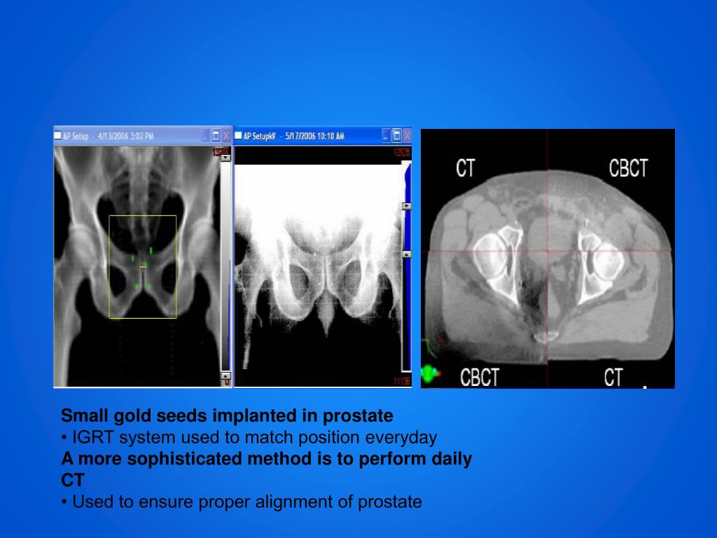 PPT - Radiation Therapy in Prostate Cancer Current Status and New ...