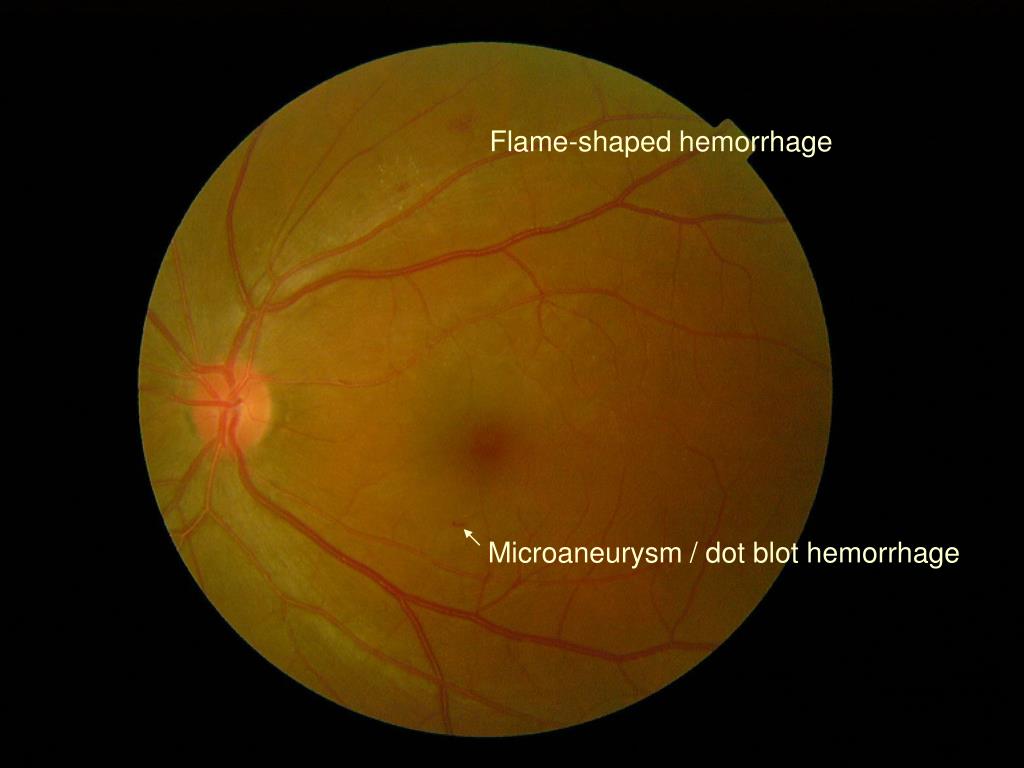 PPT - The International Classification of Diabetic Retinopathy ...
