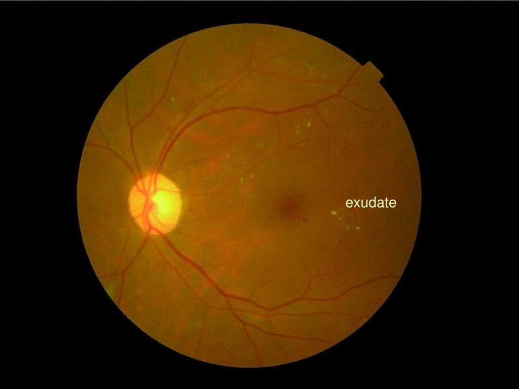 PPT - The International Classification of Diabetic Retinopathy ...