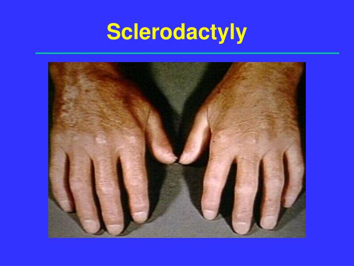 PPT - SCLERODERMA PowerPoint Presentation - ID:2762083