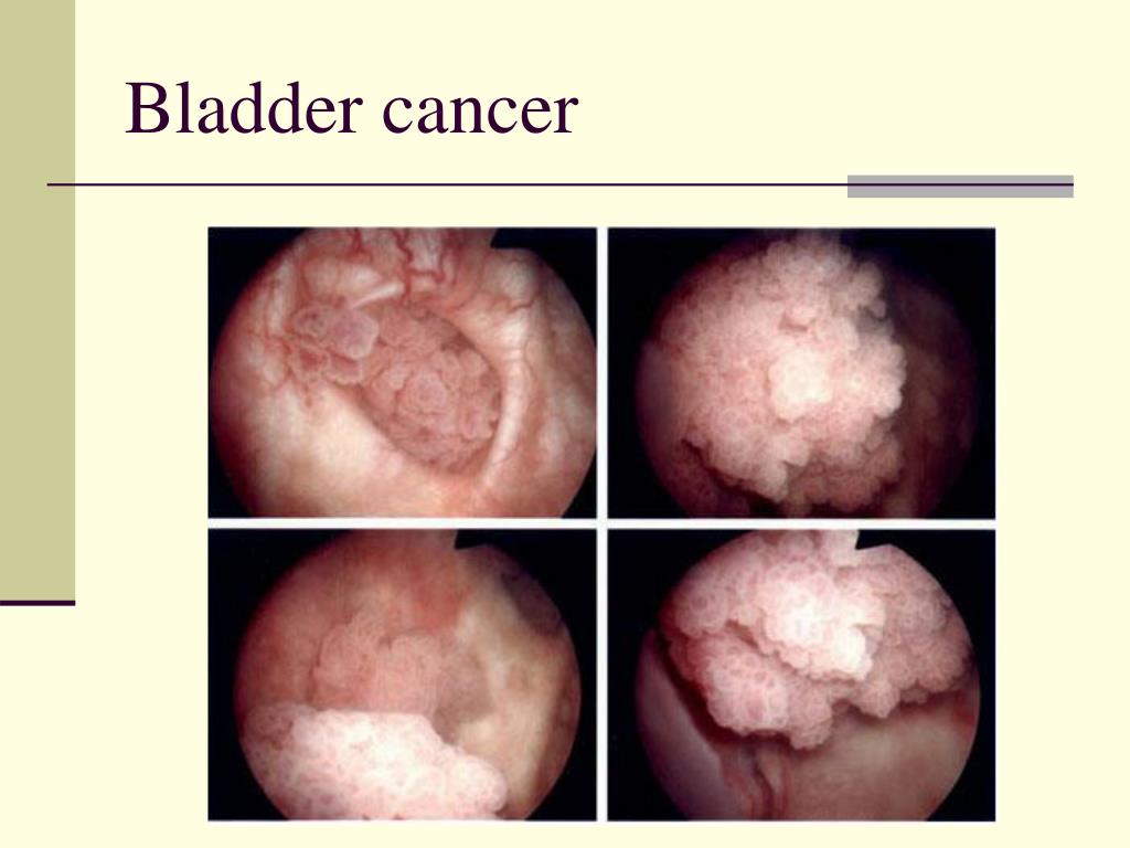 PPT - Hematuria, Kidney & Bladder Cancer for the Primary Care Physician ...