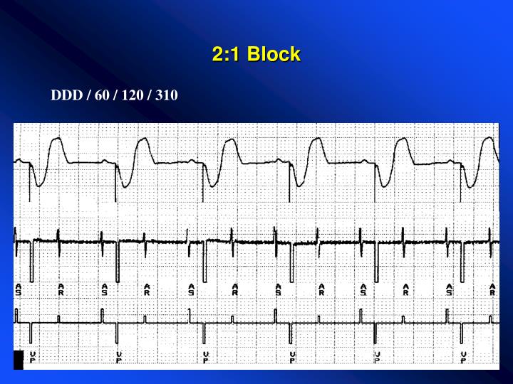 PPT - Pacemaker Timing and Intervals PowerPoint Presentation - ID:2764991