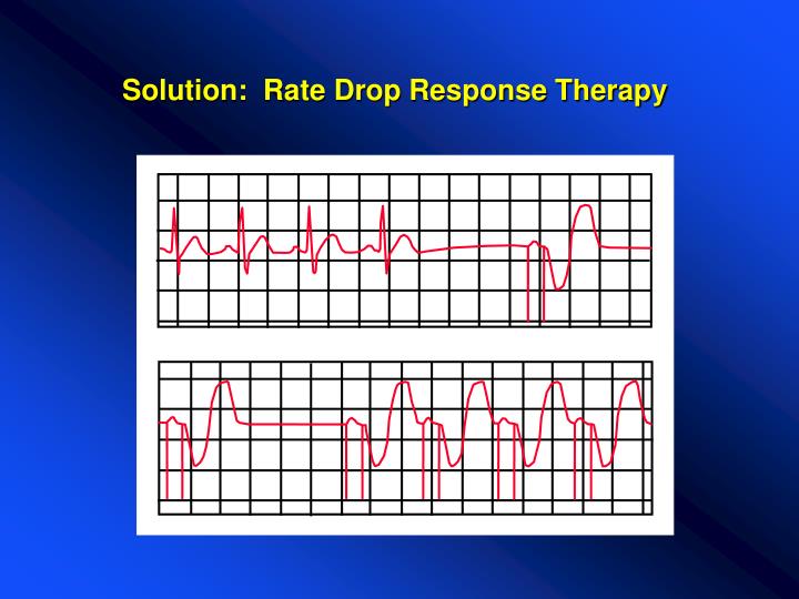PPT - Pacemaker Timing and Intervals PowerPoint Presentation - ID:2764991