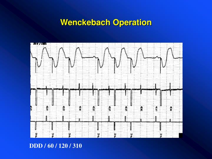 PPT - Pacemaker Timing and Intervals PowerPoint Presentation - ID:2764991