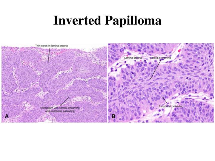 PPT - Benign Tumors of the Bladder PowerPoint Presentation - ID:2765024