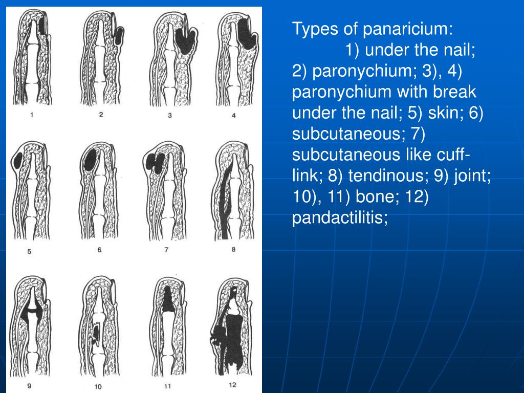 PPT - ACUTE PURULENT DISEASES OF FINGERS AND HAND. CLINIC, DIAGNOSIS ...