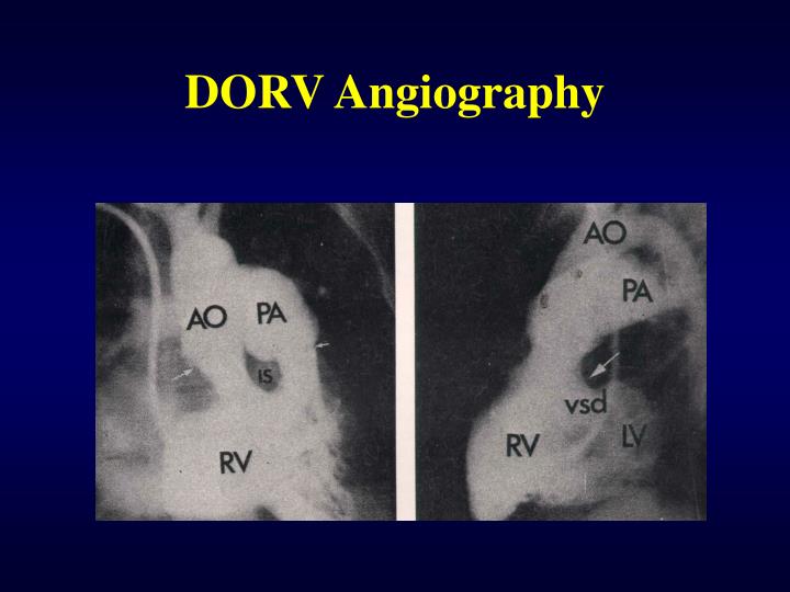 PPT - Double Outlet Right Ventricle PowerPoint Presentation - ID:2768523