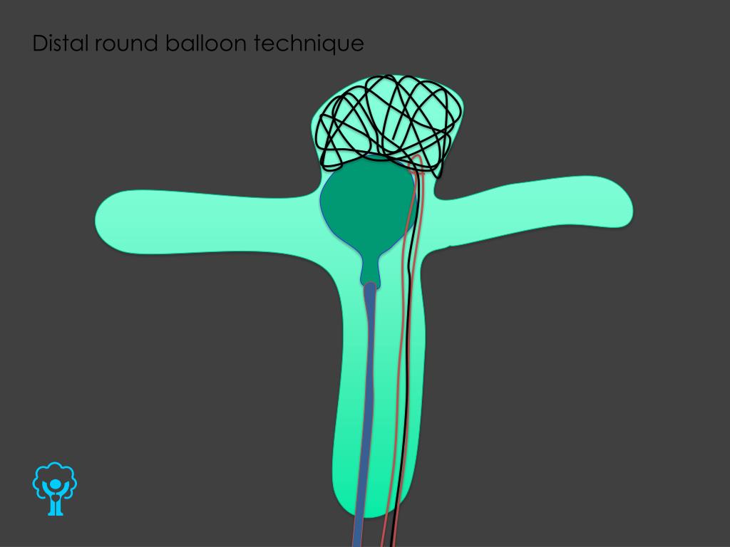 PPT - Double lumen remodeling balloon: New technique for treatment of ...