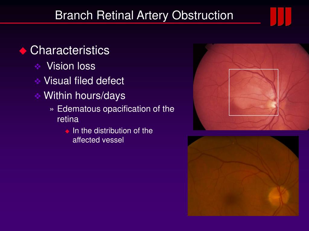 PPT - Arterial and Venous Occlusive Disease of the Retina PowerPoint ...