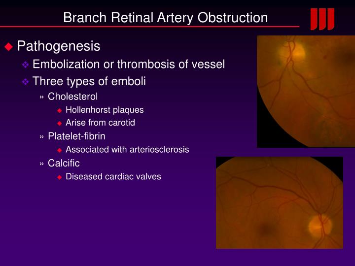 PPT - Arterial and Venous Occlusive Disease of the Retina PowerPoint ...