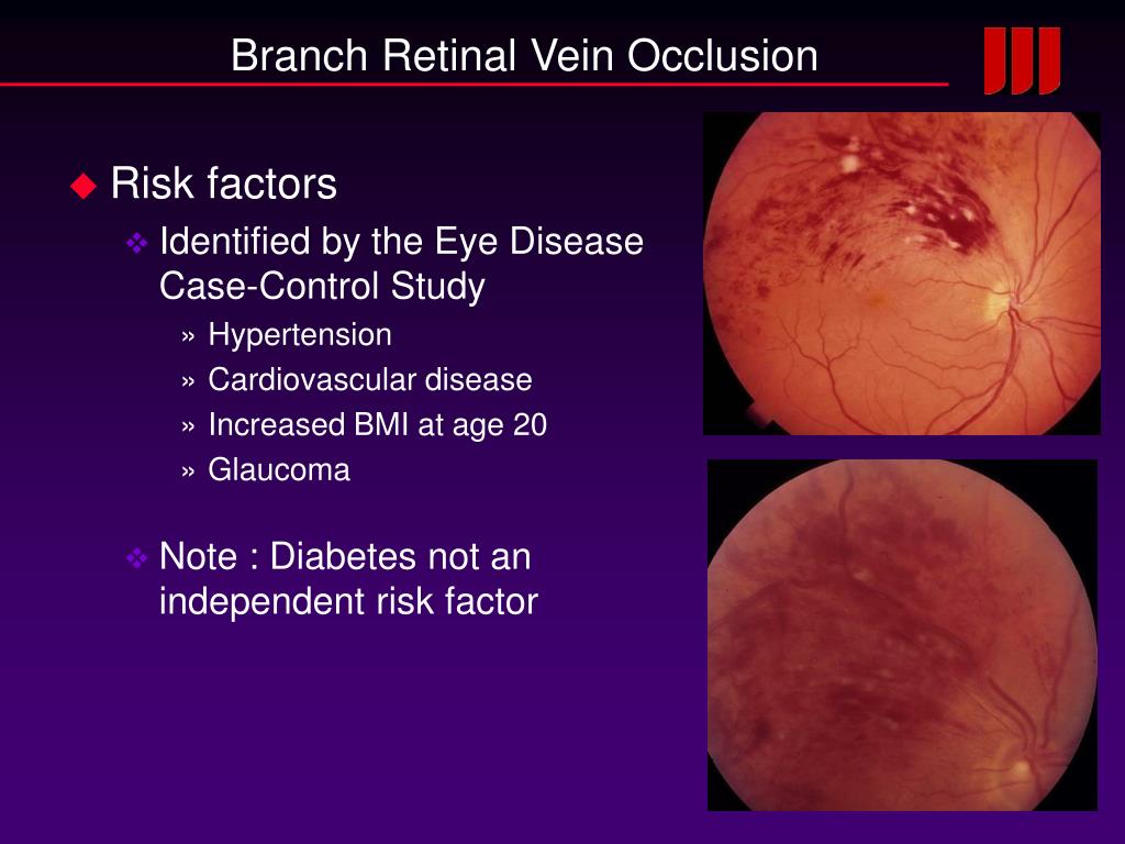 PPT - Arterial and Venous Occlusive Disease of the Retina PowerPoint ...