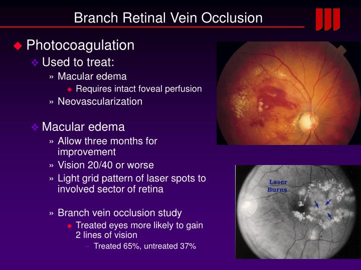 PPT - Arterial and Venous Occlusive Disease of the Retina PowerPoint ...