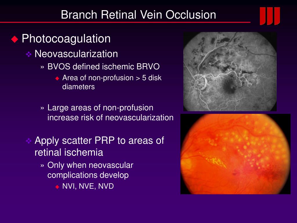 PPT - Arterial and Venous Occlusive Disease of the Retina PowerPoint ...