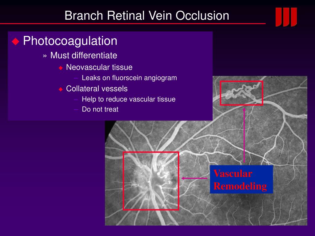 PPT - Arterial and Venous Occlusive Disease of the Retina PowerPoint ...