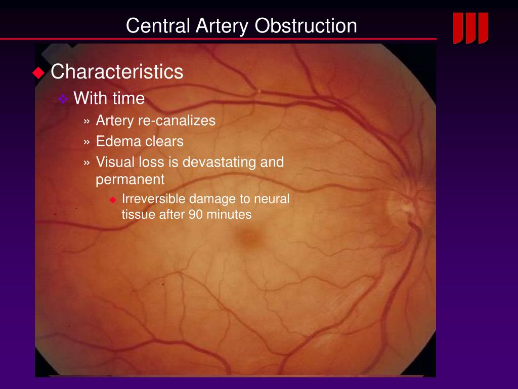 PPT - Arterial and Venous Occlusive Disease of the Retina PowerPoint ...