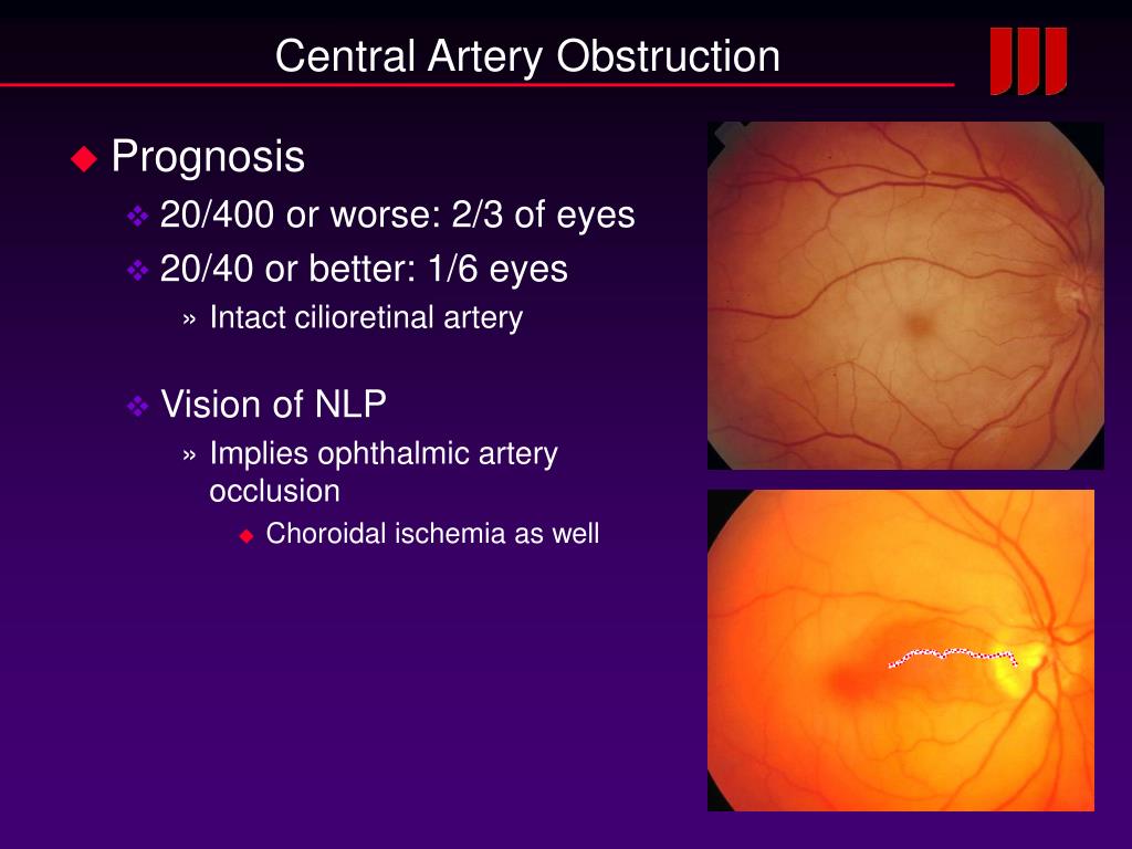 PPT - Arterial and Venous Occlusive Disease of the Retina PowerPoint ...