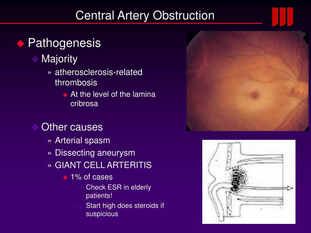 PPT - Arterial and Venous Occlusive Disease of the Retina PowerPoint ...