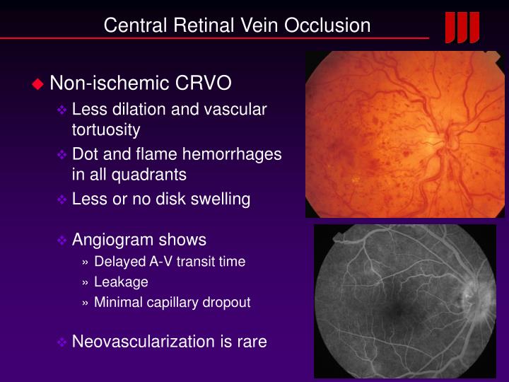 PPT - Arterial and Venous Occlusive Disease of the Retina PowerPoint ...