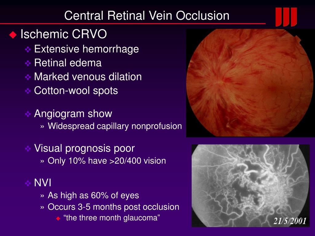 PPT - Arterial and Venous Occlusive Disease of the Retina PowerPoint ...