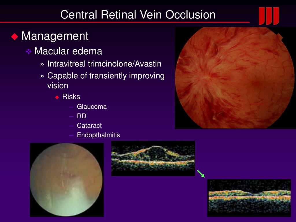 PPT - Arterial and Venous Occlusive Disease of the Retina PowerPoint ...