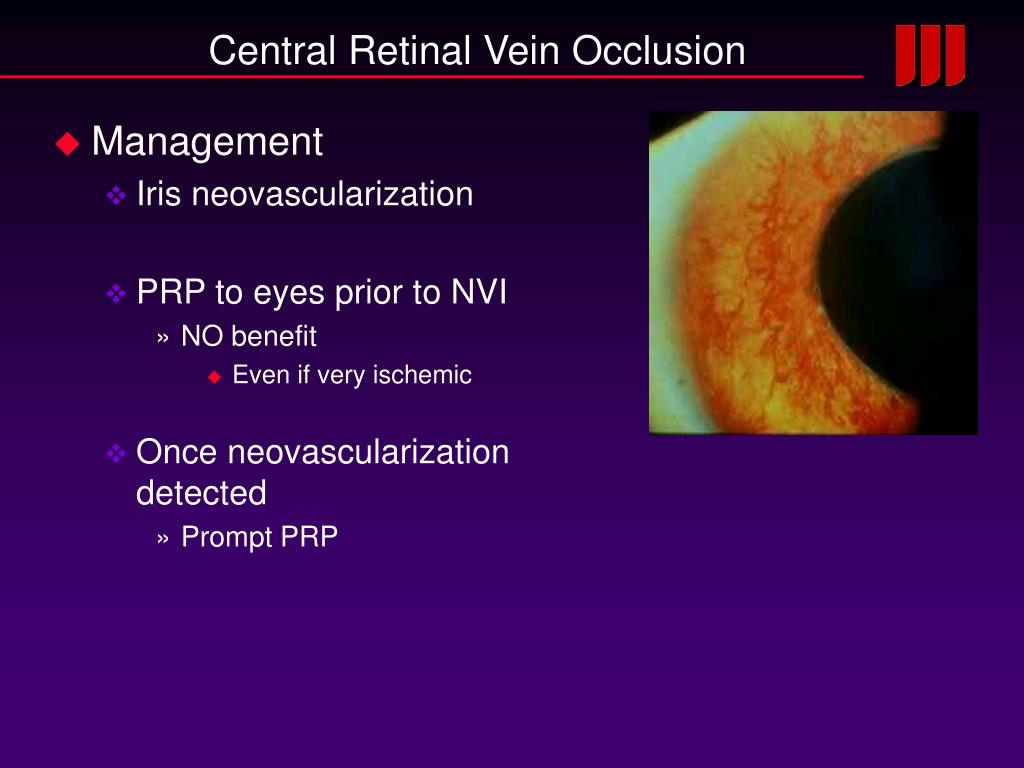 PPT - Arterial and Venous Occlusive Disease of the Retina PowerPoint ...