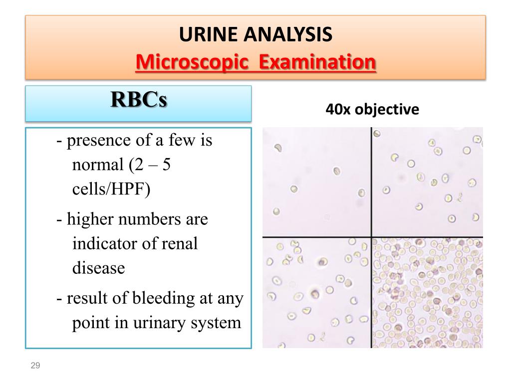 Microscopic Urinalysis Result Interpretation Chart at Tami Jake blog Microscopic Urinalysis Result Interpretation Chart at Tami Jake blog