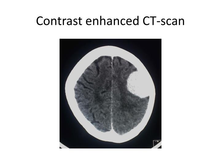 PPT - Neurosurgery Case 2: CNS Neoplasms PowerPoint Presentation - ID ...