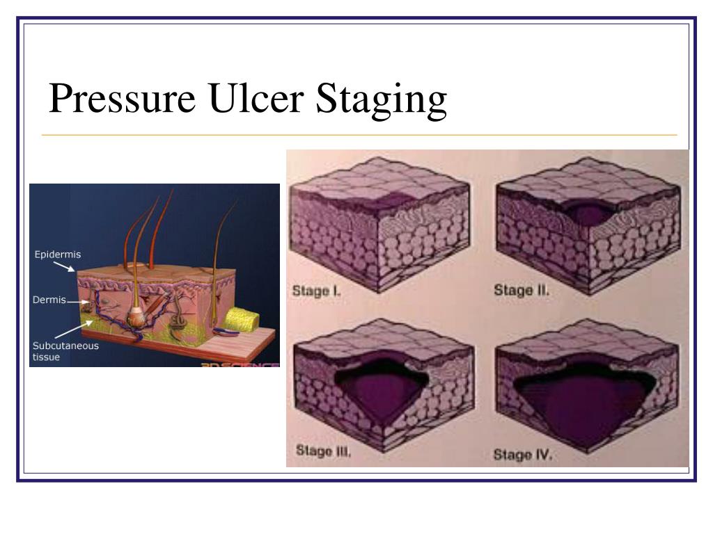 Ppt Pressure Ulcers Powerpoint Presentation Free Download Id 2776919
